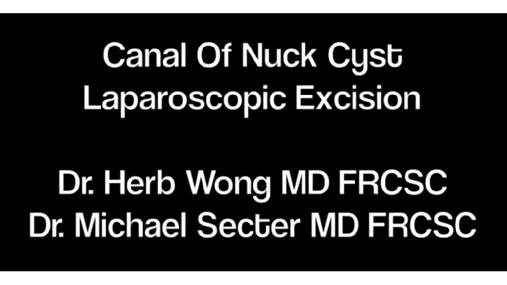 Canal Of Nuck Cyst Laparoscopic Excision
