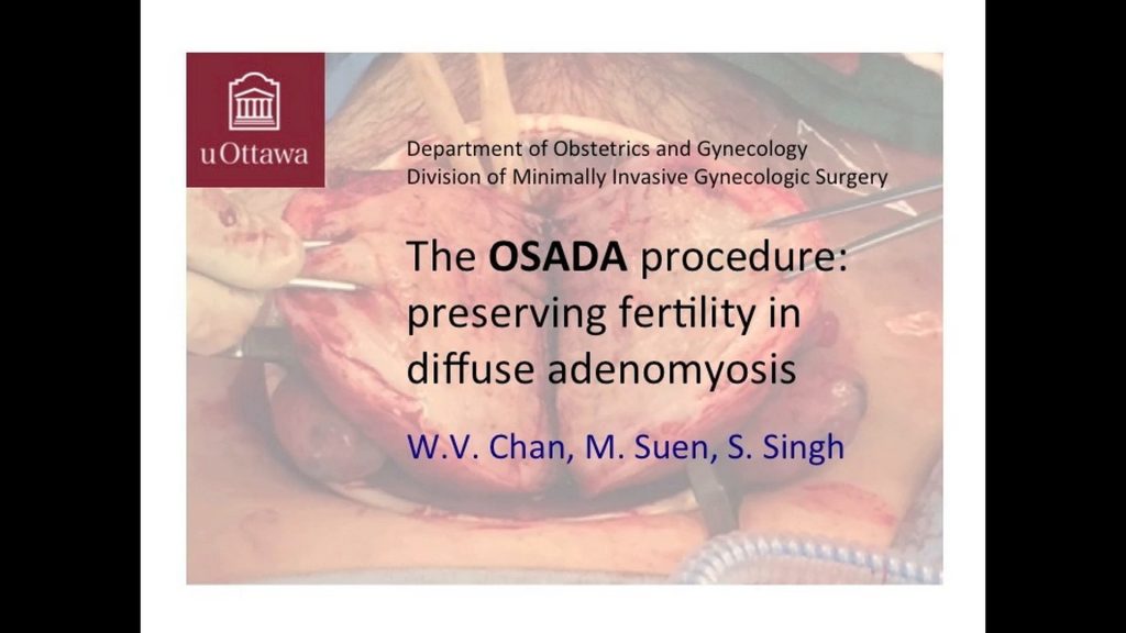 OSADA Procedure: Preserving Fertility in Diffuse Adenomyosis