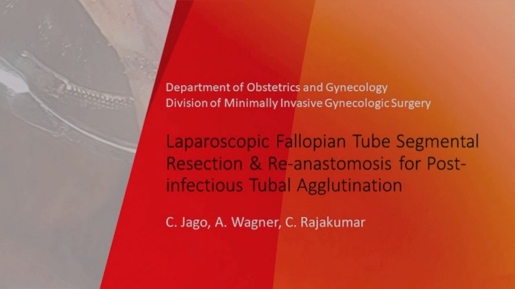 Laparoscopic Fallopian Tube Segmental Resection