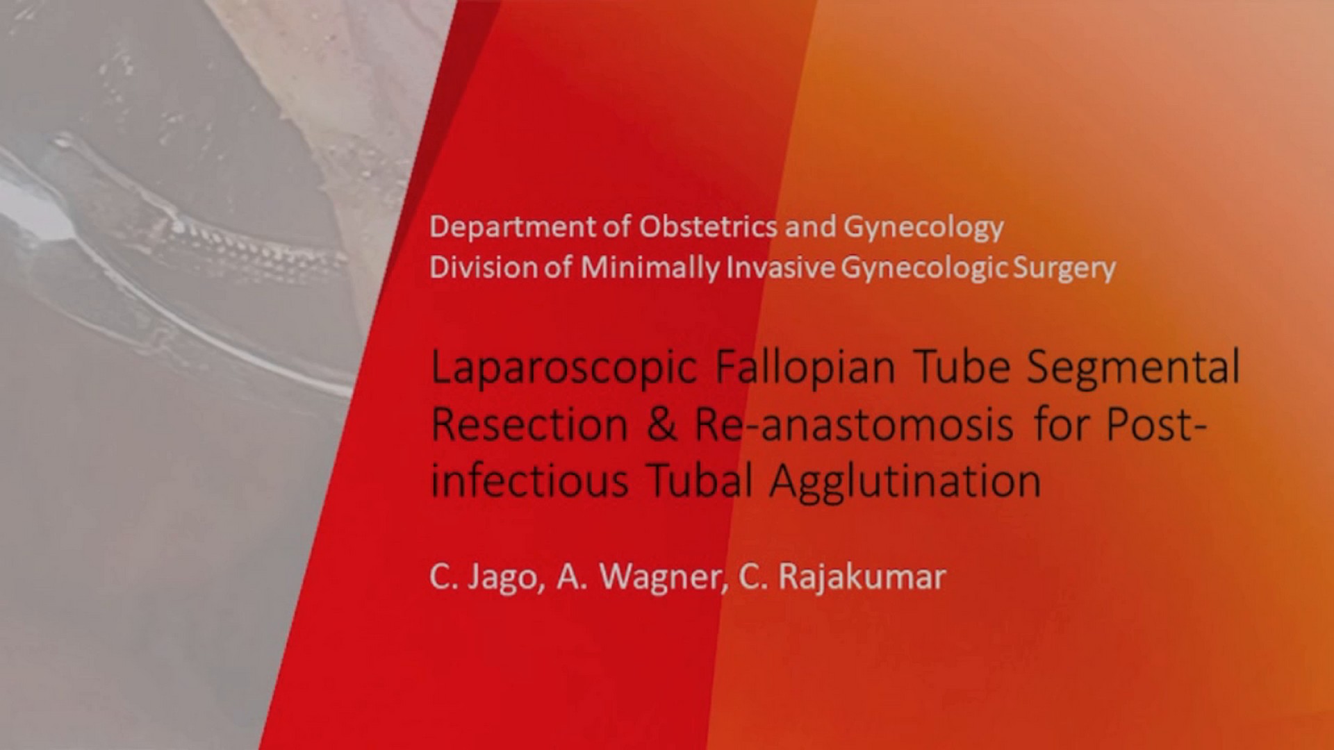 Laparoscopic Fallopian Tube Segmental Resection