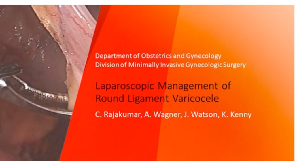 Laparoscopic Management of Round Ligament Varicocele