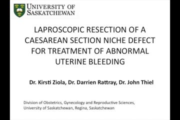 Laparoscopic Resection of a Caesarean Section Niche Defect