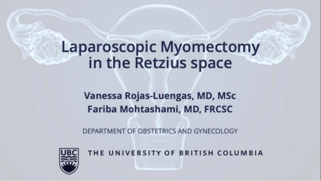 [VIDEO] Laparoscopic Myomectomy in the Retzius Space