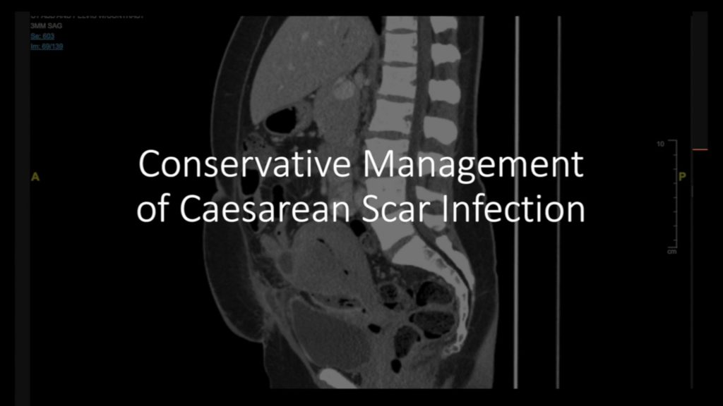 [VIDEO] Conservative Management of Caesarean Scar Infection