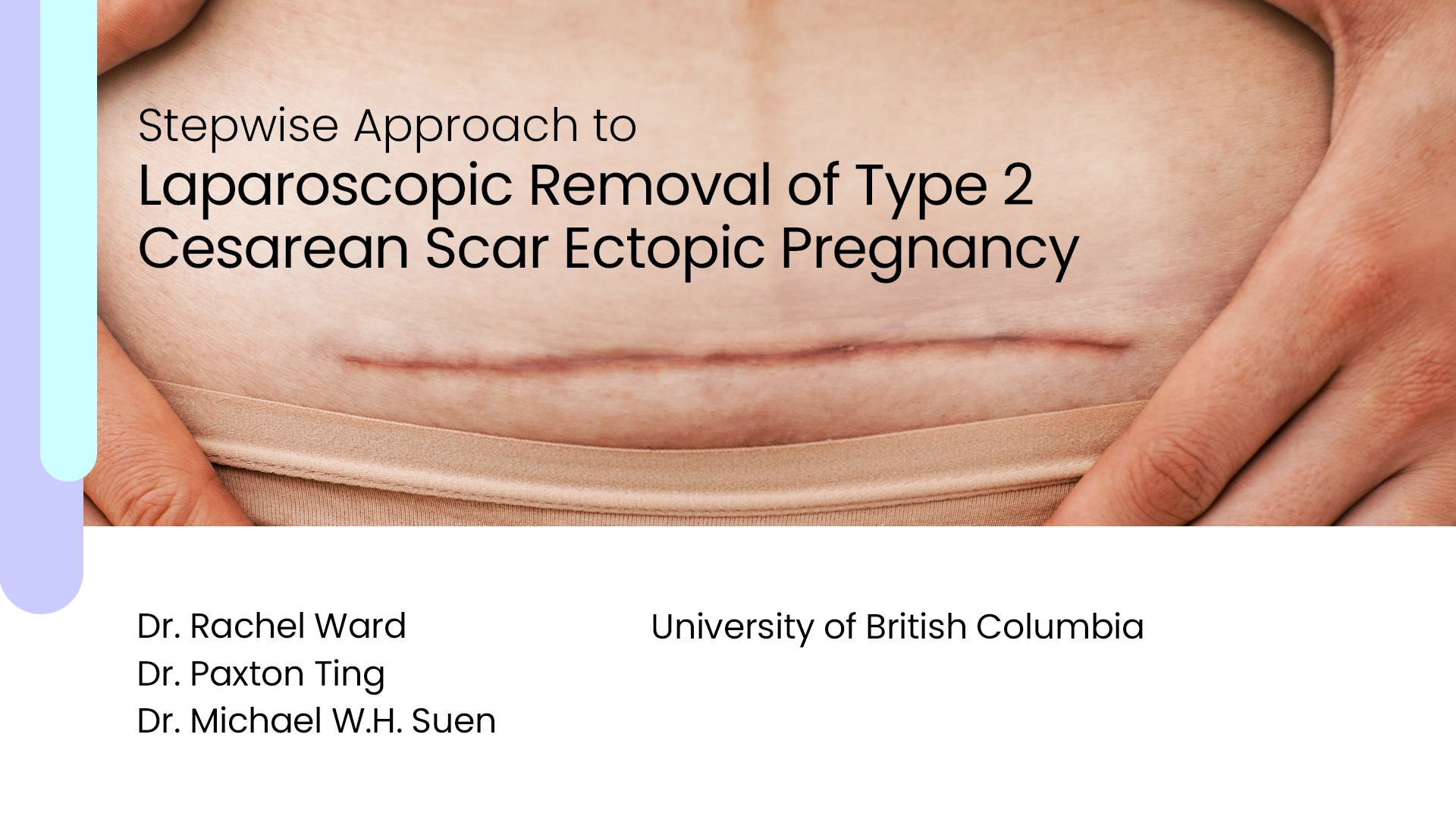Laparoscopic Removal of Type 2 Scar Ectopic